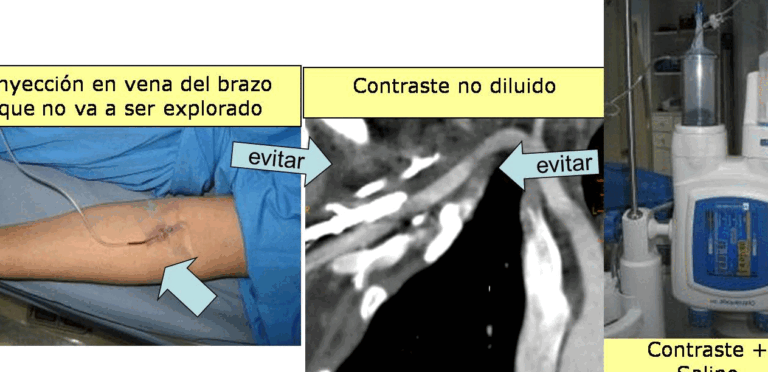 ️ ¡Tenga Cuidado Con El Absceso Axilar - CIE 10! ⚡ InfoAxilas