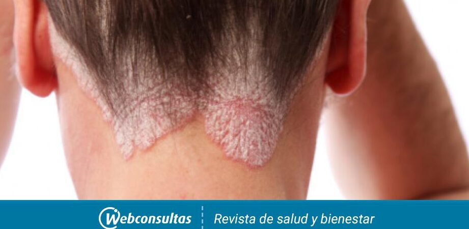 ️ Psoriasis Axilar: Cómo Tratarlo ⚡ InfoAxilas
